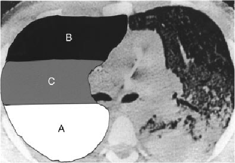 Tratamiento del SDRA. Fundamentos actuales