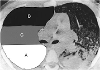 Tratamiento del SDRA. Fundamentos actuales