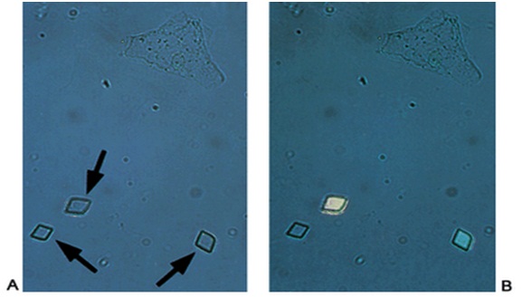 What's New Today?: Mikroskopis urinalysis - Kristal Kristal dalam urine