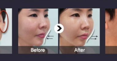 Renewme Skin Clinic Indonesia: Jenis FILLER yang digunakan di Renewme ...