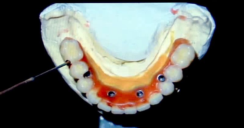 VIDEOCONFERÊNCIA: Prótese Protocolo Imediata Inferior - Odonto-Tv