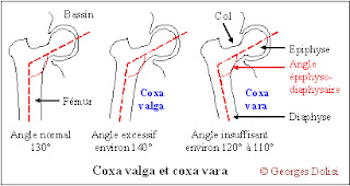 Coxa valga ~ Anatomy for MSP