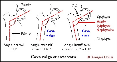 Coxa valga ~ Anatomy for MSP