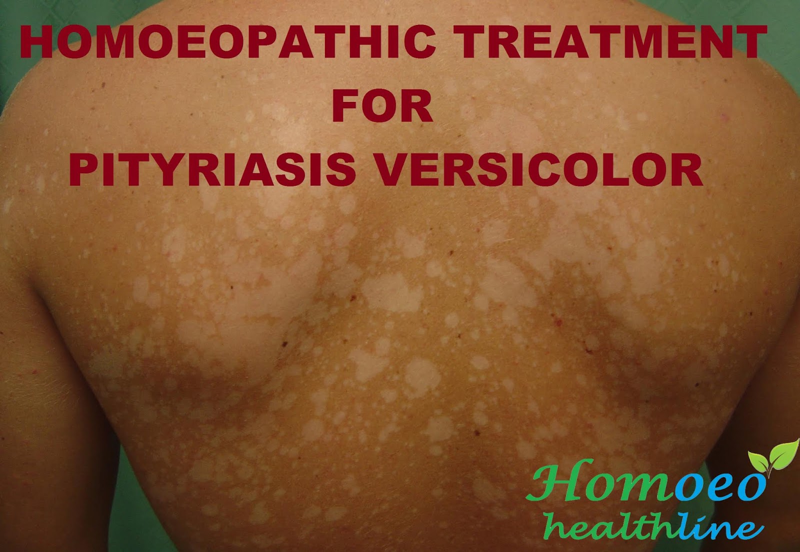 PITYRIASIS VERSICOLOR HOMOEOPATHY pityriasis-versicolor-homoeopathy