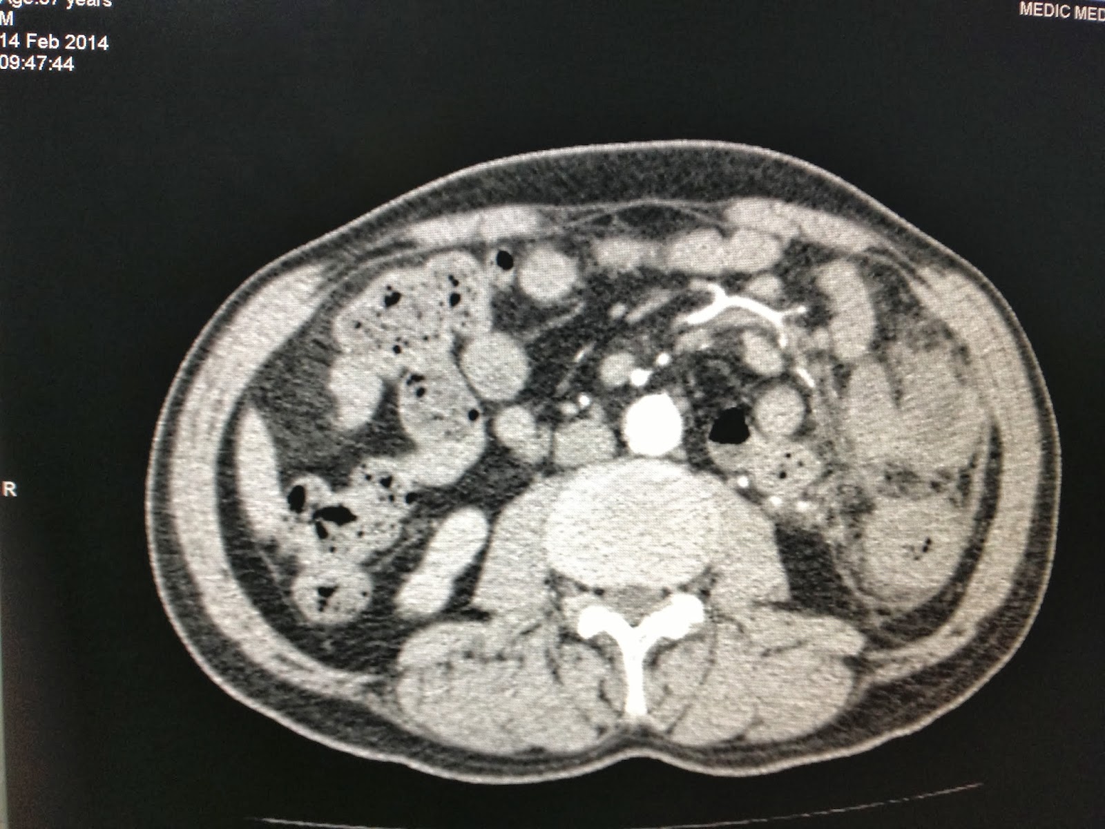 VIETNAMESE MEDIC ULTRASOUND: CASE 239: COLON TUMOR and WALLED-OFF ...