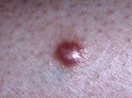 Fly High : Dermatofibroma Surgery