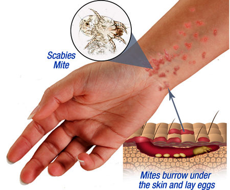 Obat Luka Pasca Operasi Caesar: Salep Penghilang Kudis Dan Bekasnya