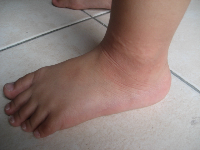 DIARI ALYA: GIGITAN HAMA TILAM ...BOLEH DIRAWATI DENGAN BEDAK MUNTAH ...