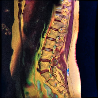 Nevit's blog: Color MRI of the Lumbar vertebrae