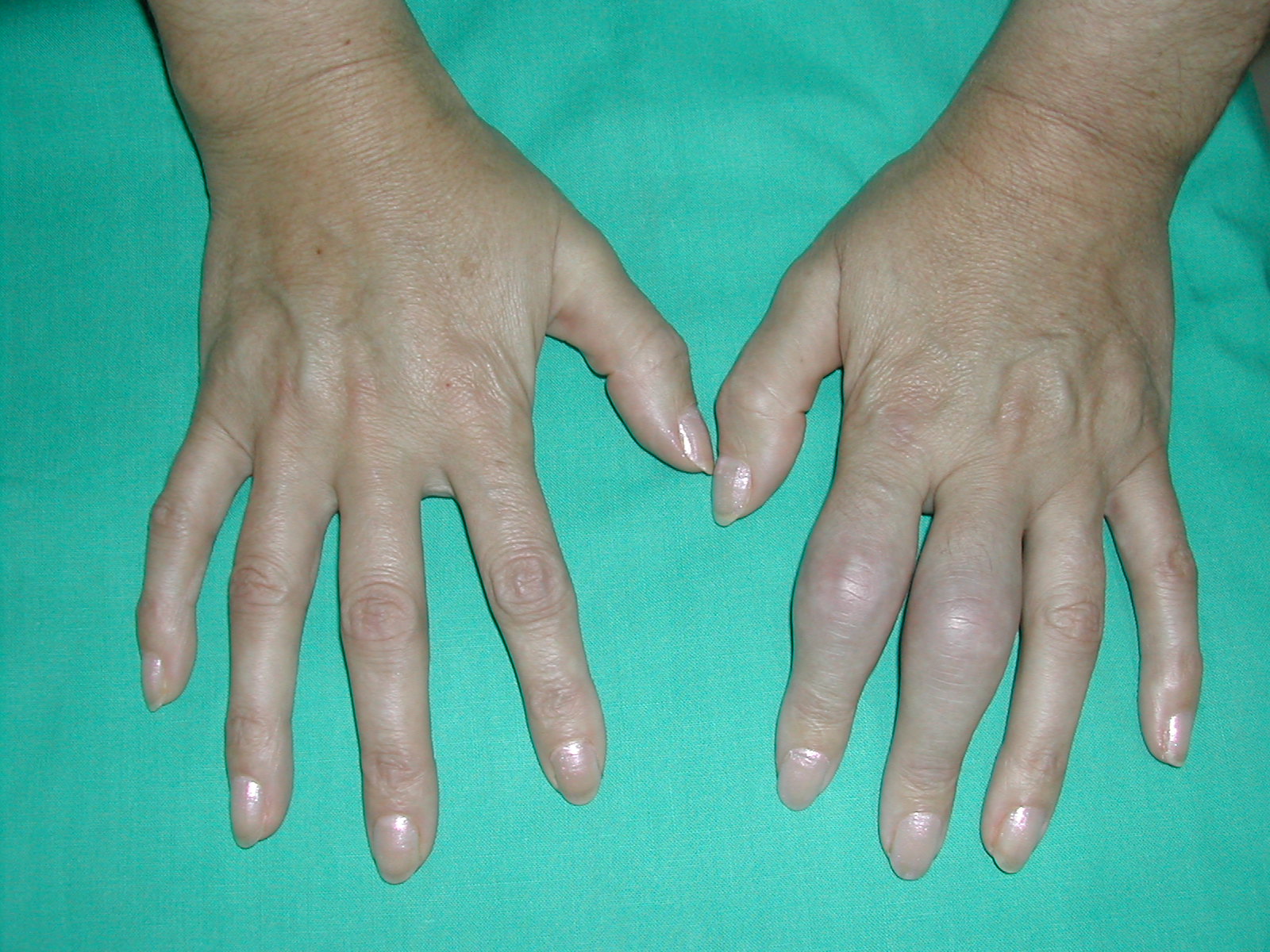 SALUD Y NUTRICIÓN: HIPERURICEMIA Y GOTA