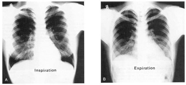 dioramaduniaku: Membaca Rontgen Toraks Normal