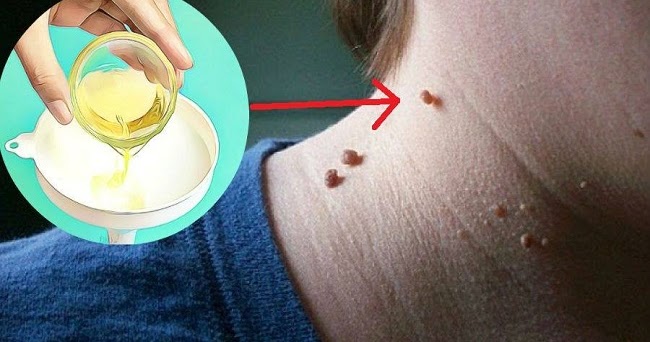 How To Remove Fibroma And Other Skin Warts All By Yourself