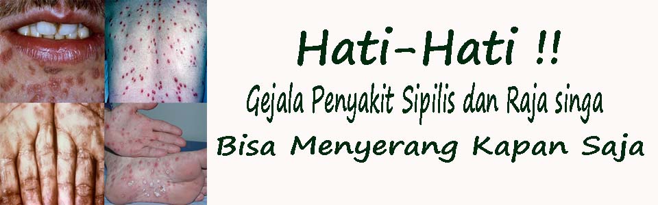 Ciri ciri penyakit sipilis atau raja singa