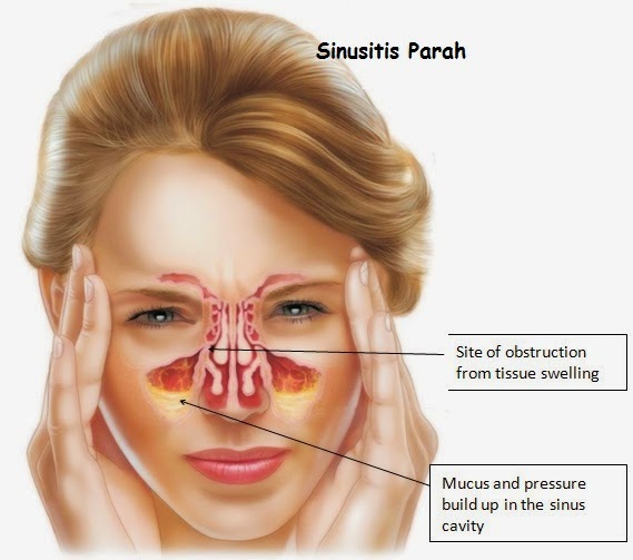 Sinusitis Yang Sudah Parah, Inilah Rasanya | Kesehatan