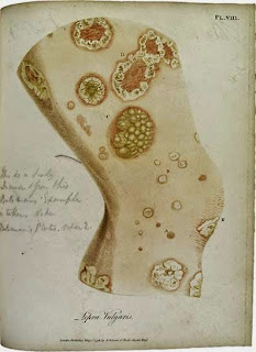 Un dermatólogo en el museo : Robert Willan, el primer dermatólogo?