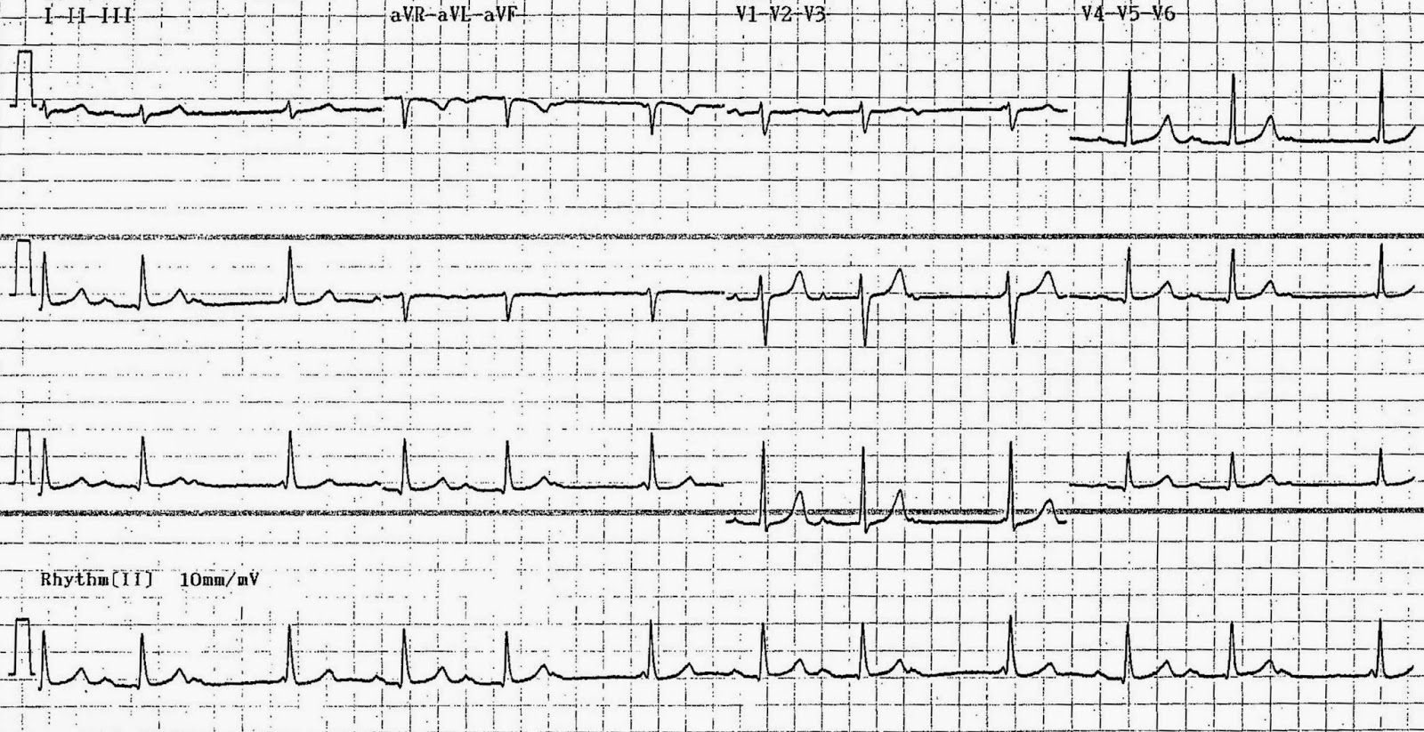 ECG of the Week: ECG of the Week - 3rd February 2014 - Interpretation