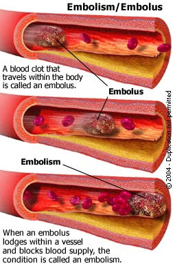 Locky's English Playground: Medical: Thrombosis VS Embolism VS ...