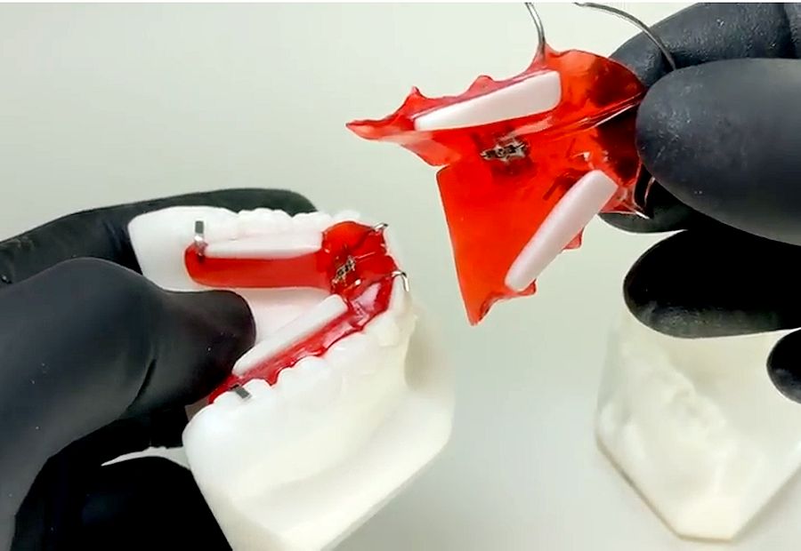 BRUXISMO Infantil - Pistas Planas Simples - Odonto-Tv