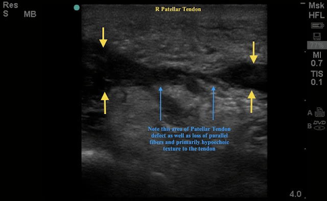 Patellar Tendon Rupture ~ Ultrasound Cases Info