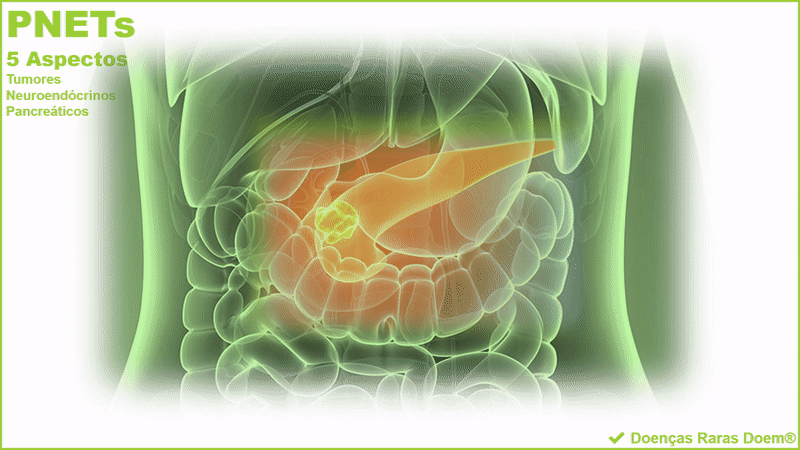 Doenças Raras Doem®: 5 Principais Aspectos sobre os PNETs - Tumores ...
