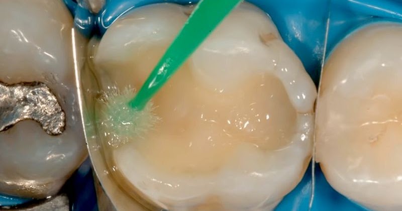 OPERATIVE DENTISTRY: Indirect Posterior Resin Composite Restorations ...