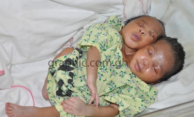 Conjoined Twins born in Ghana won’t survive separation – Doctor | This ...
