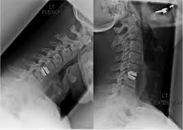 Medical Treatment Pictures-for Better Understanding: Spinal Disc ...