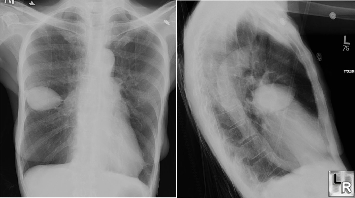 Imagining Imaging: EGGSHELL CALCIFICATION
