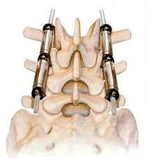Spine Update 脊椎新事: DYNAMIC STABILIZATION?