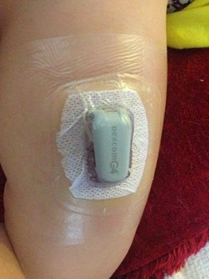 Our Journey with a Type 1 Diabetes Diagnosis: The Dreaded Dexcom Rash