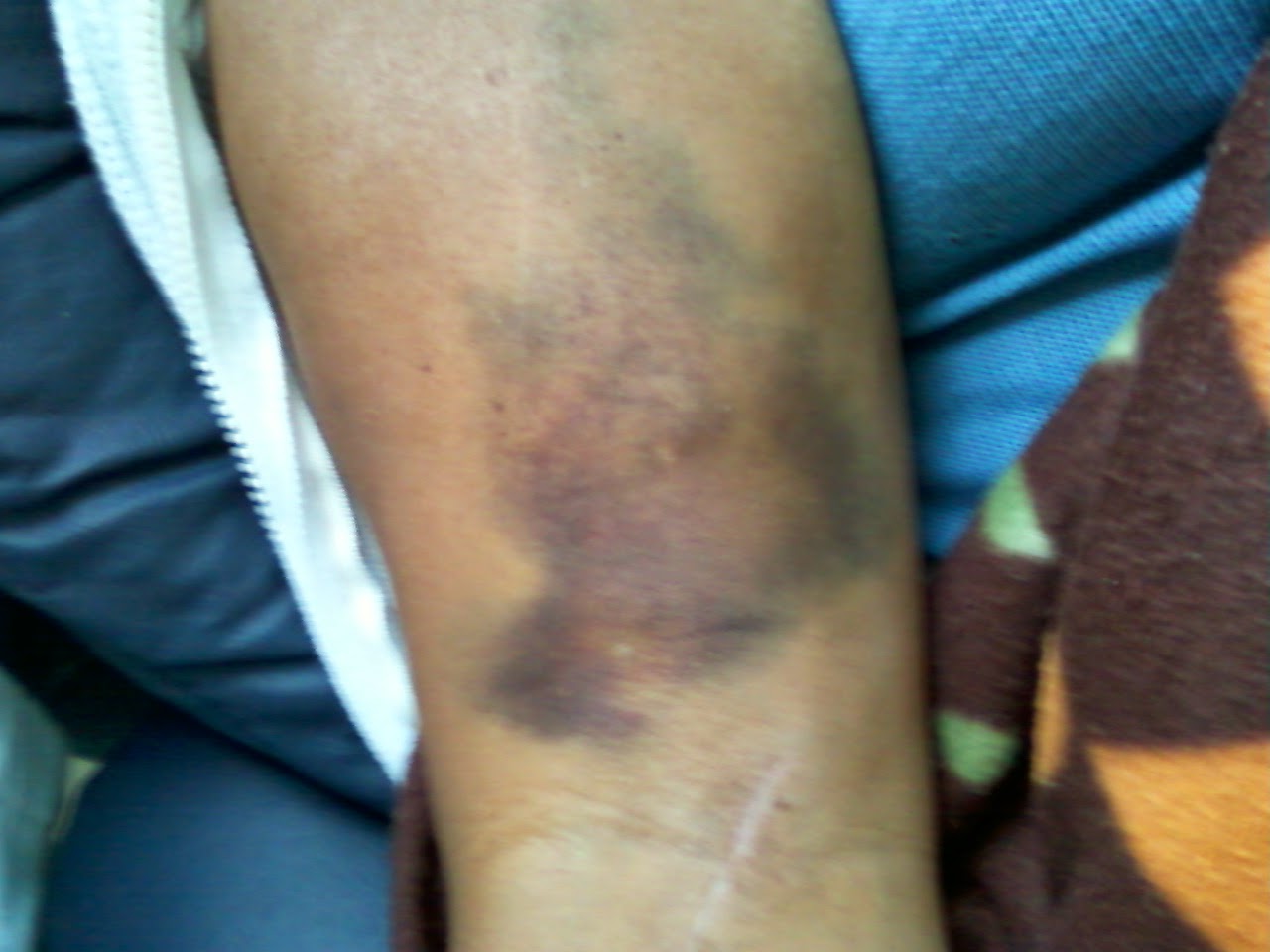 FISIOTERAPIA VOLTADA PARA FÍSTULA ARTERIOVENOSA: INFILTRAÇÃO DE FÍSTULA ...