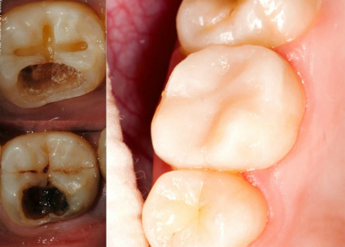 5 Tips on How to Reverse Cavities and Heal Tooth Decay Naturally at ...