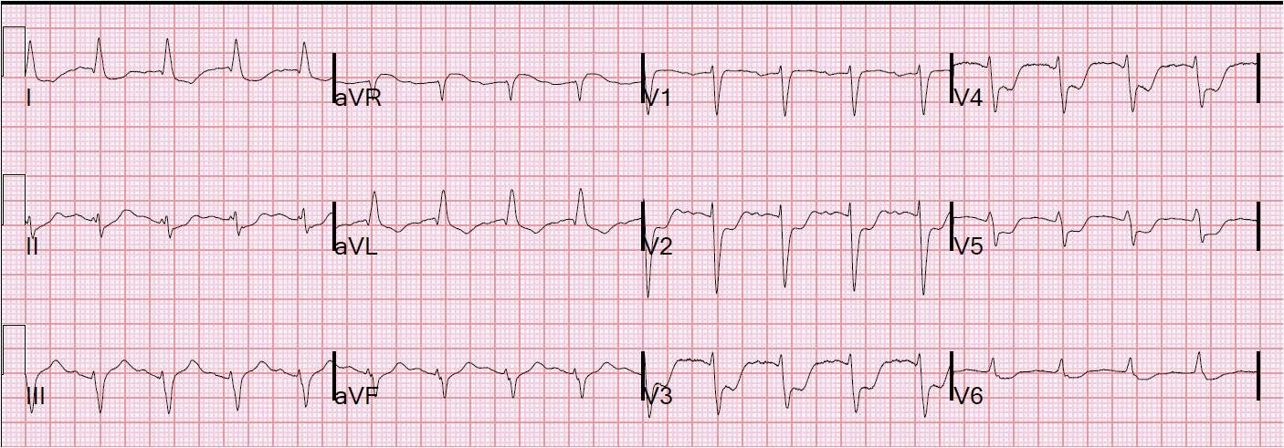 Dr. Smith's ECG Blog: Beware confusing the diagnosis of posterior STEMI ...
