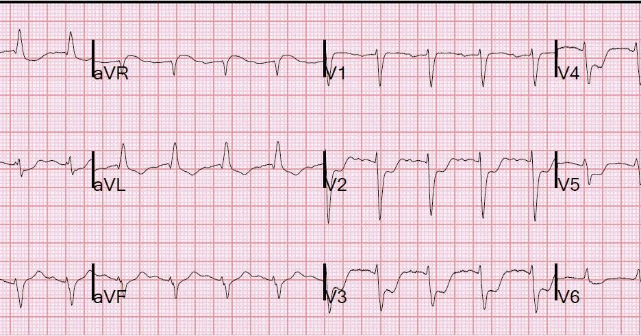 Dr. Smith's ECG Blog: Beware confusing the diagnosis of posterior STEMI ...