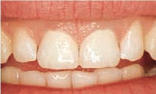 Dentistry lectures for MFDS/MJDF/NBDE/ORE: A Note On Types Of Ceramic ...