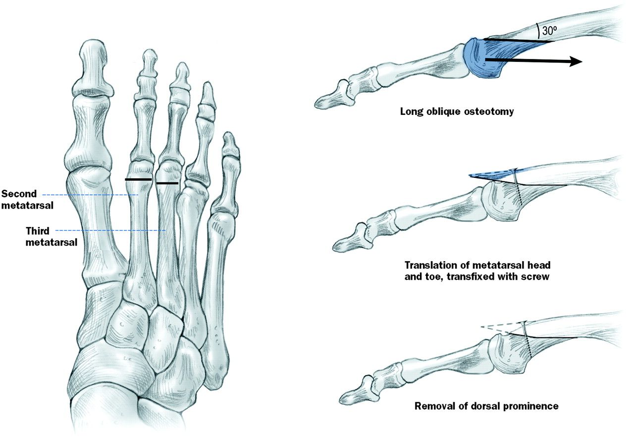 足踝筆記: 4月 2017