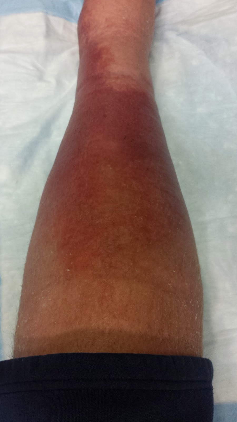 BubbaMike's Ramblings: Cellulitis (warning, graphic photos in this post)