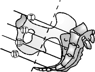 Ginecologia y Obstetricia: Planos de Hodge y De Lee