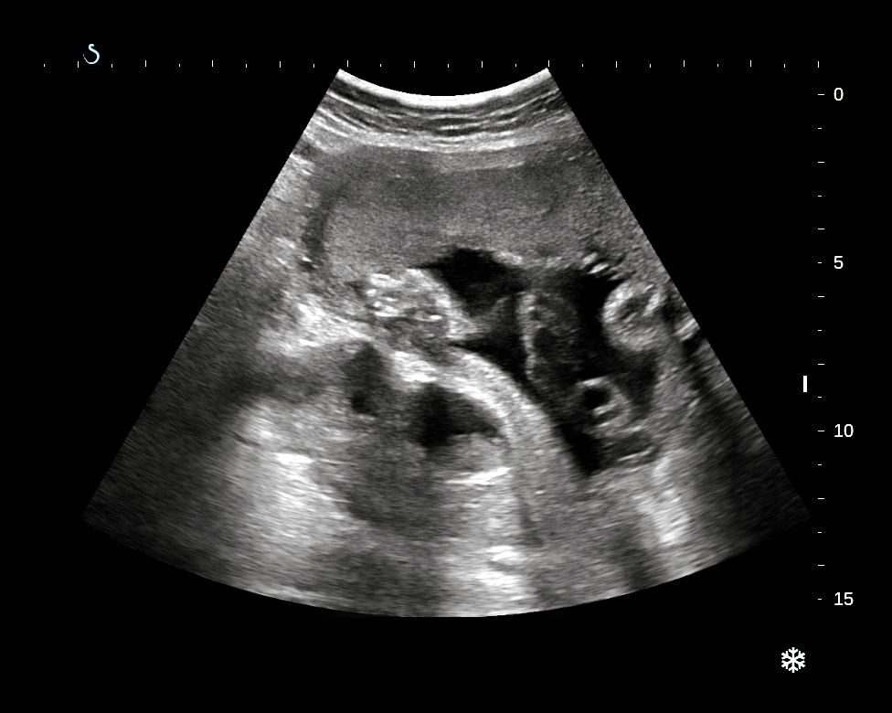 Abdominal Flutter Early Pregnancy