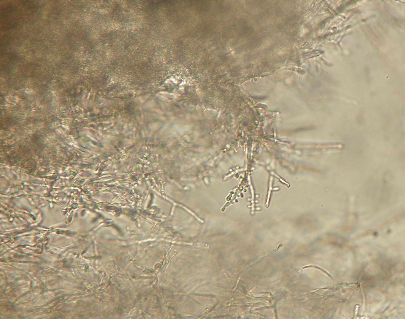 ATLAS MICOLOGIA: SICOSE POR TRICHOPHYTON MENTAGROPHYTES