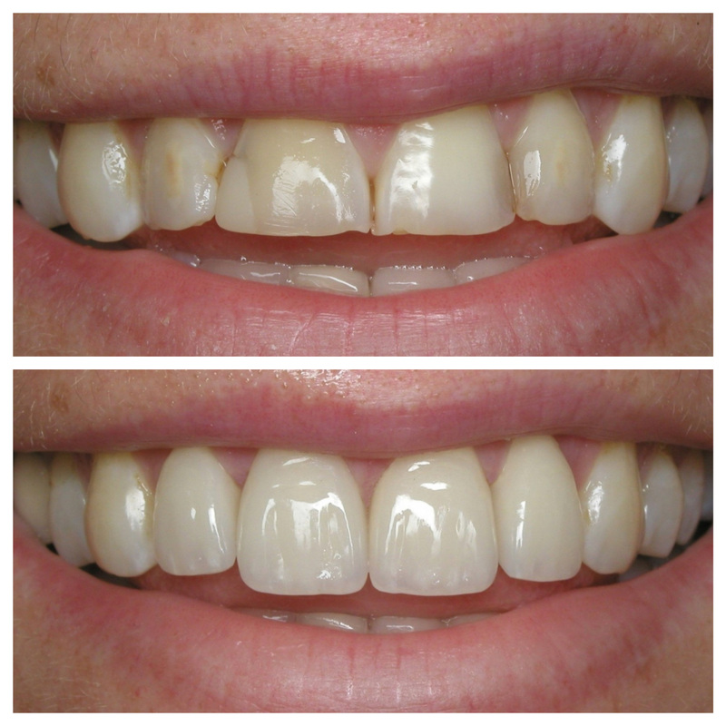 GrindRelief N: Shortening, Thinning and Chipping of Front Teeth Causes