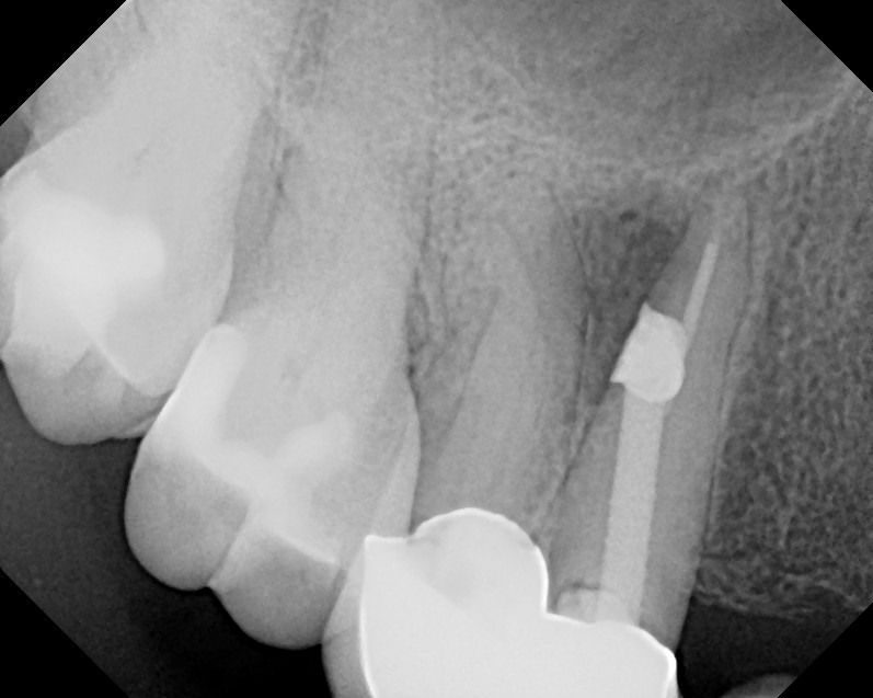Perforation Repair Endodontics at Kevin House blog