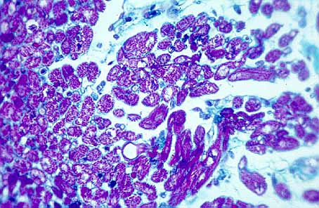 Patología 2013: MIOCARDIOPATÍAS