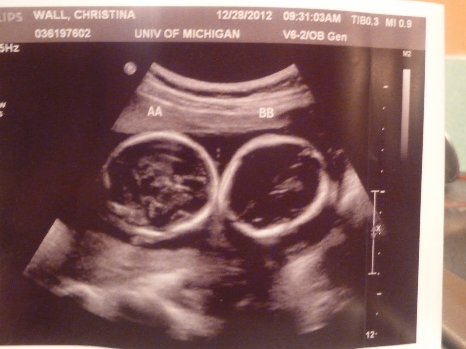 Baby Bitty Twins: 18 week ultrasound pics