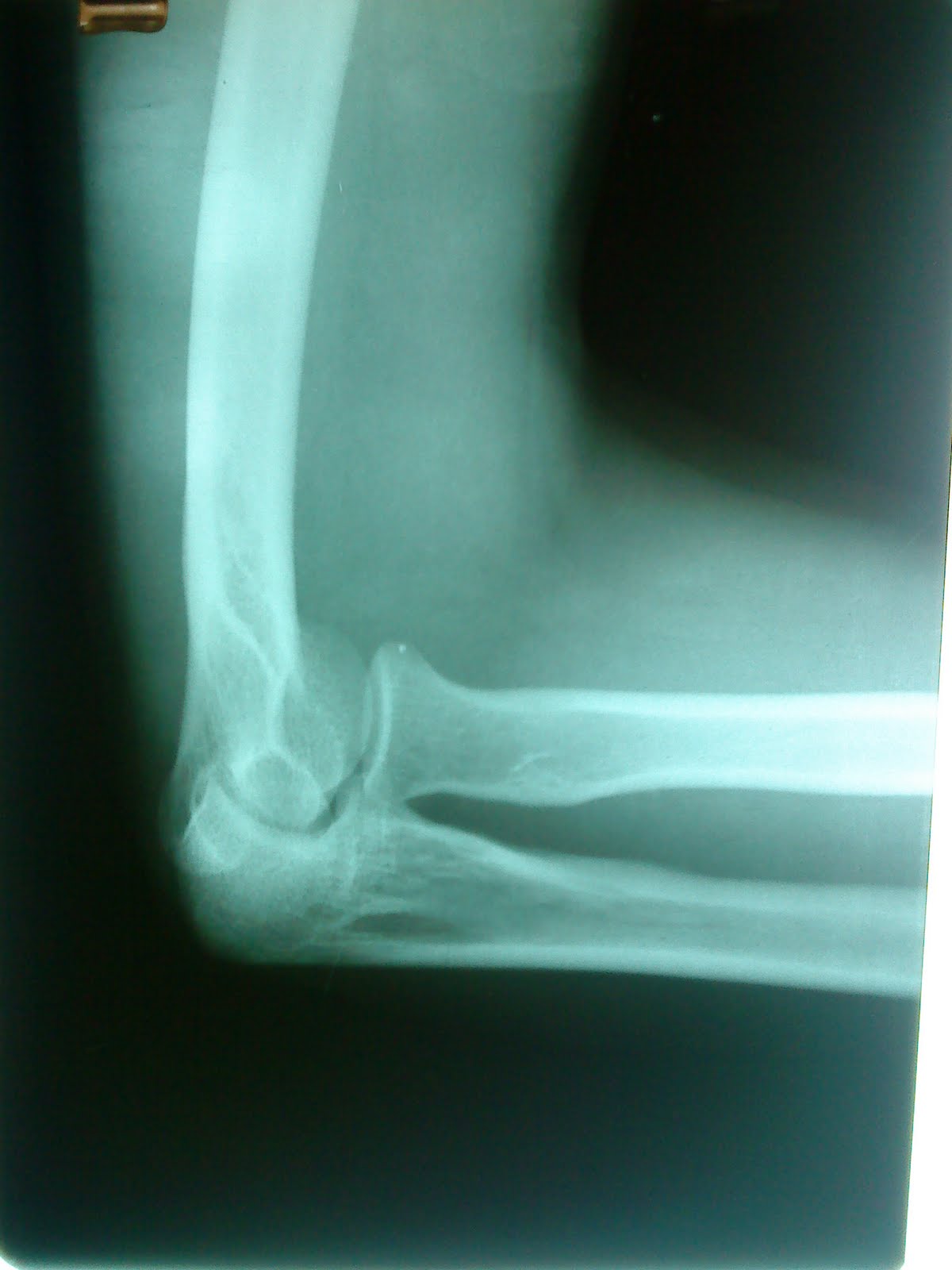 grupoRx4: Codo Cabeza de Radio Proyeccion lateral (lateromedial)