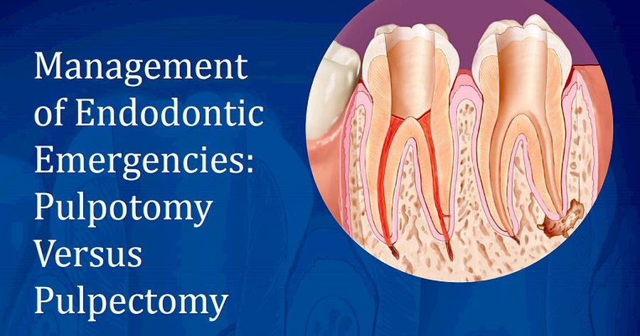 PDF: Management of Endodontic Emergencies: Pulpotomy Versus Pulpectomy ...