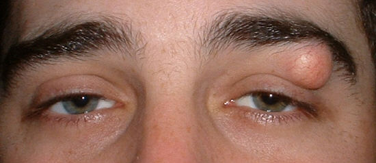 Penyebab, Gejala dan Pengobatan Kista Epidermoid Tanpa Operasi - Tips ...