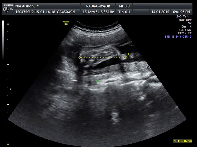 CiNtA HaTi Ku: scan 3d 4d di klinik fauziah ampang