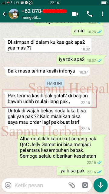 Obat Pusar Bernanah, Berair dan Bau utk Bayi, Anak & Dewasa - Blog ...