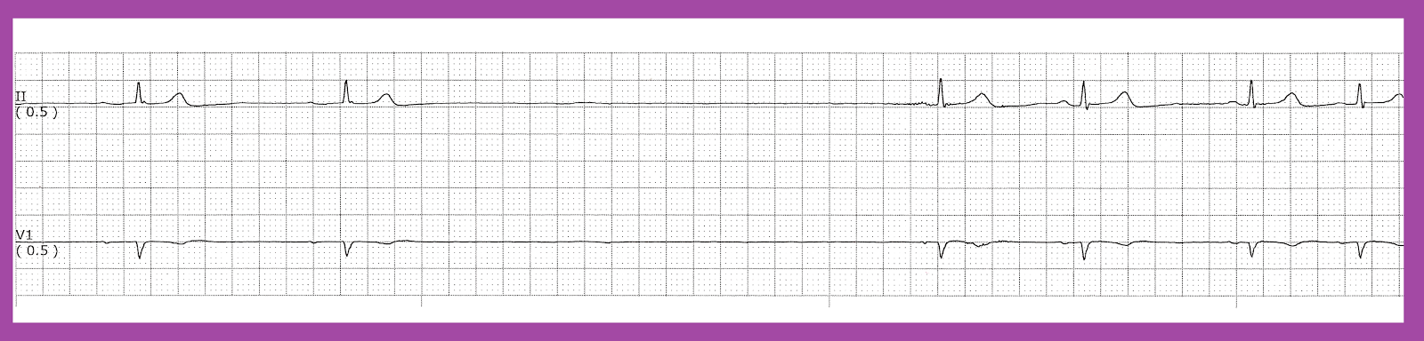 Various Sinus Arrests and Sinus Pauses